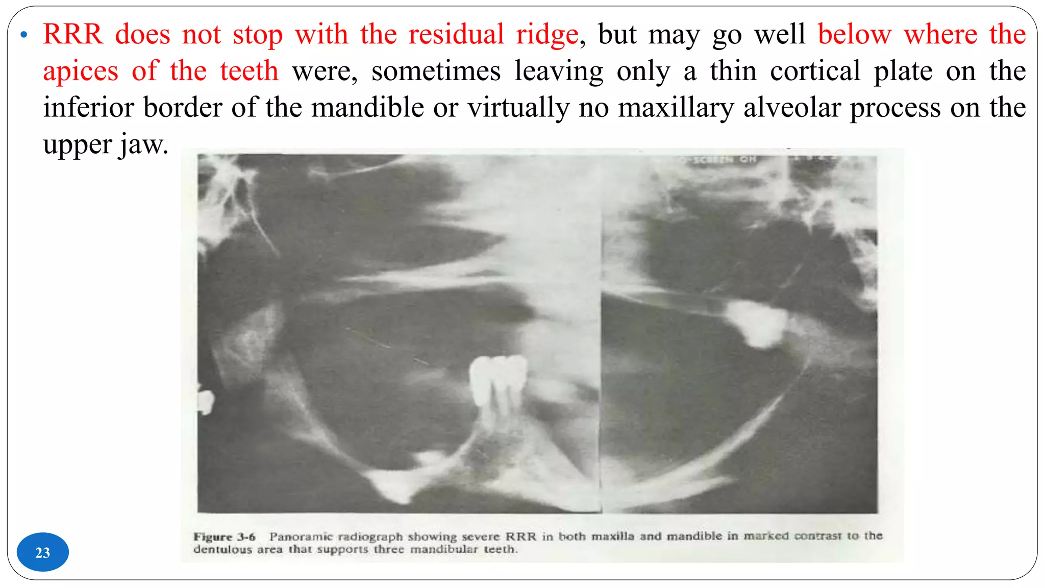 Resisual Ridge Resorption | PPTX