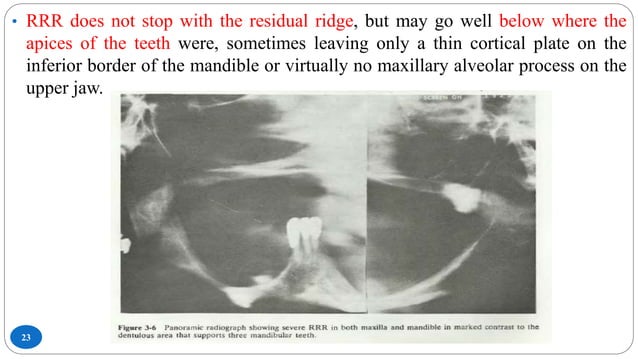 Resisual Ridge Resorption | PPTX