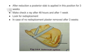 Supracondylar fracture of humerus | PPTX