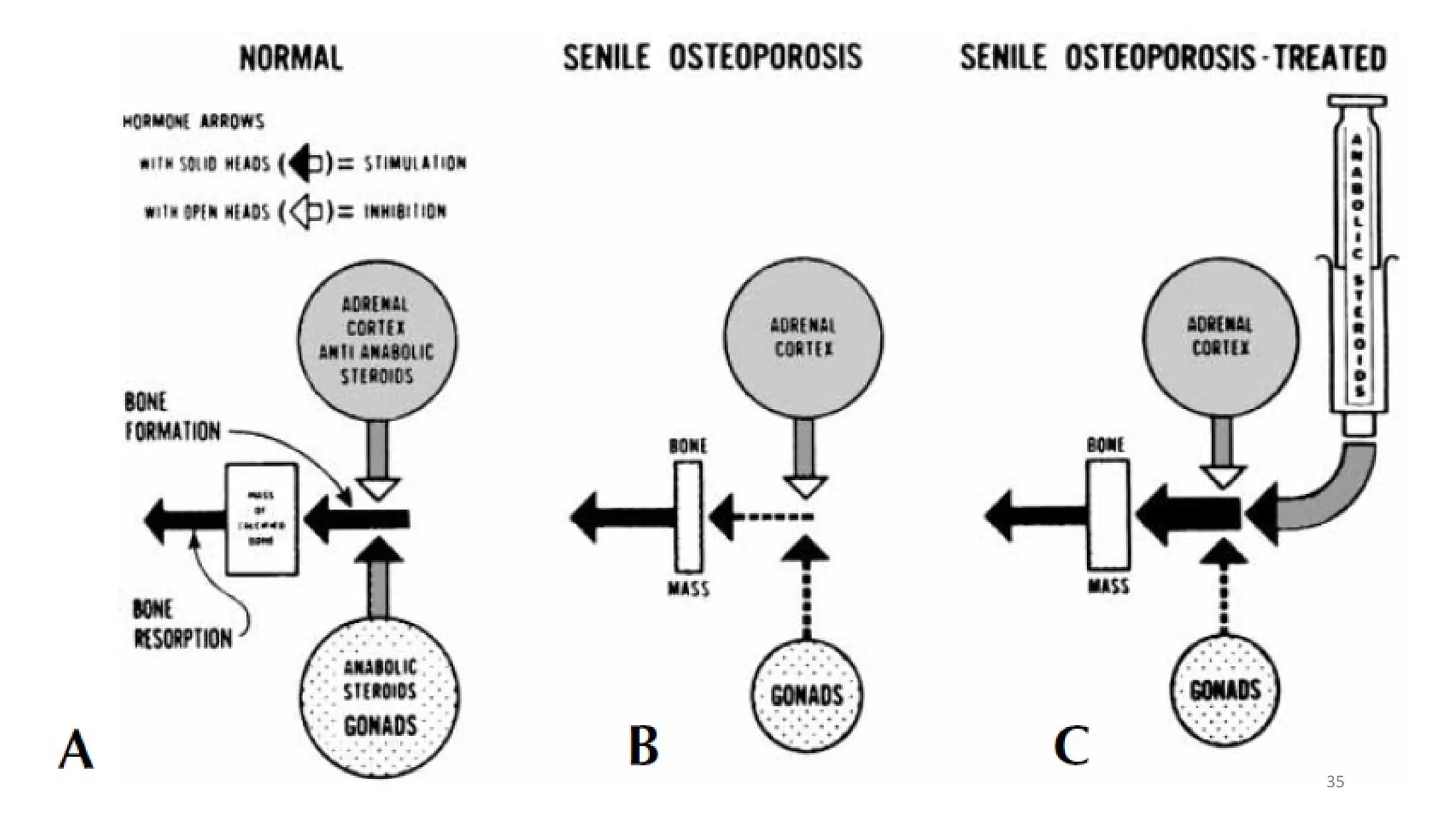 Residual Ridge Resorption in Prosthodontics .ppt