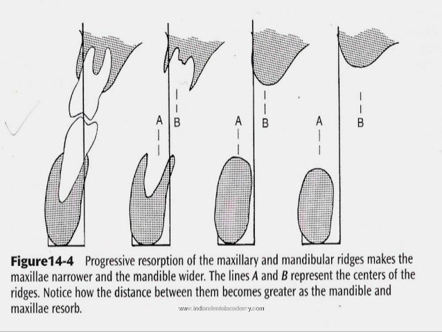 Residual ridge resorption /certified fixed orthodontic courses by Ind…