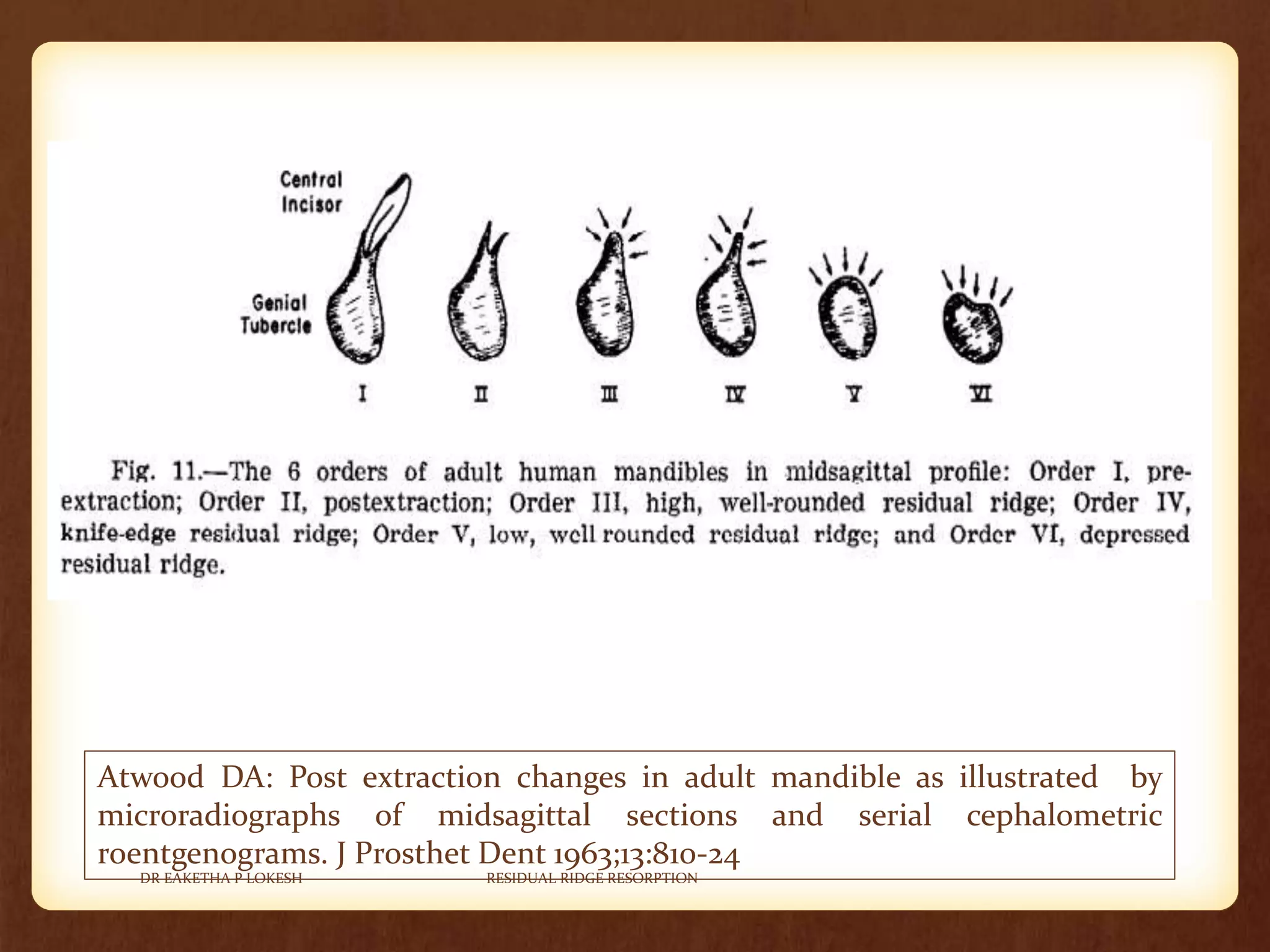 Residual ridge resorption - RRR | PPTX
