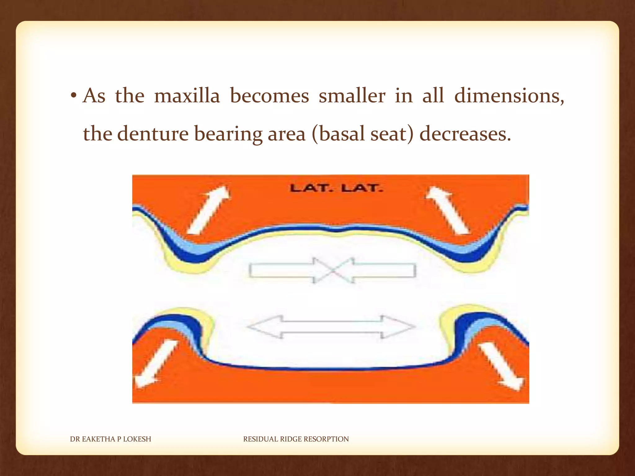Residual ridge resorption - RRR | PPTX