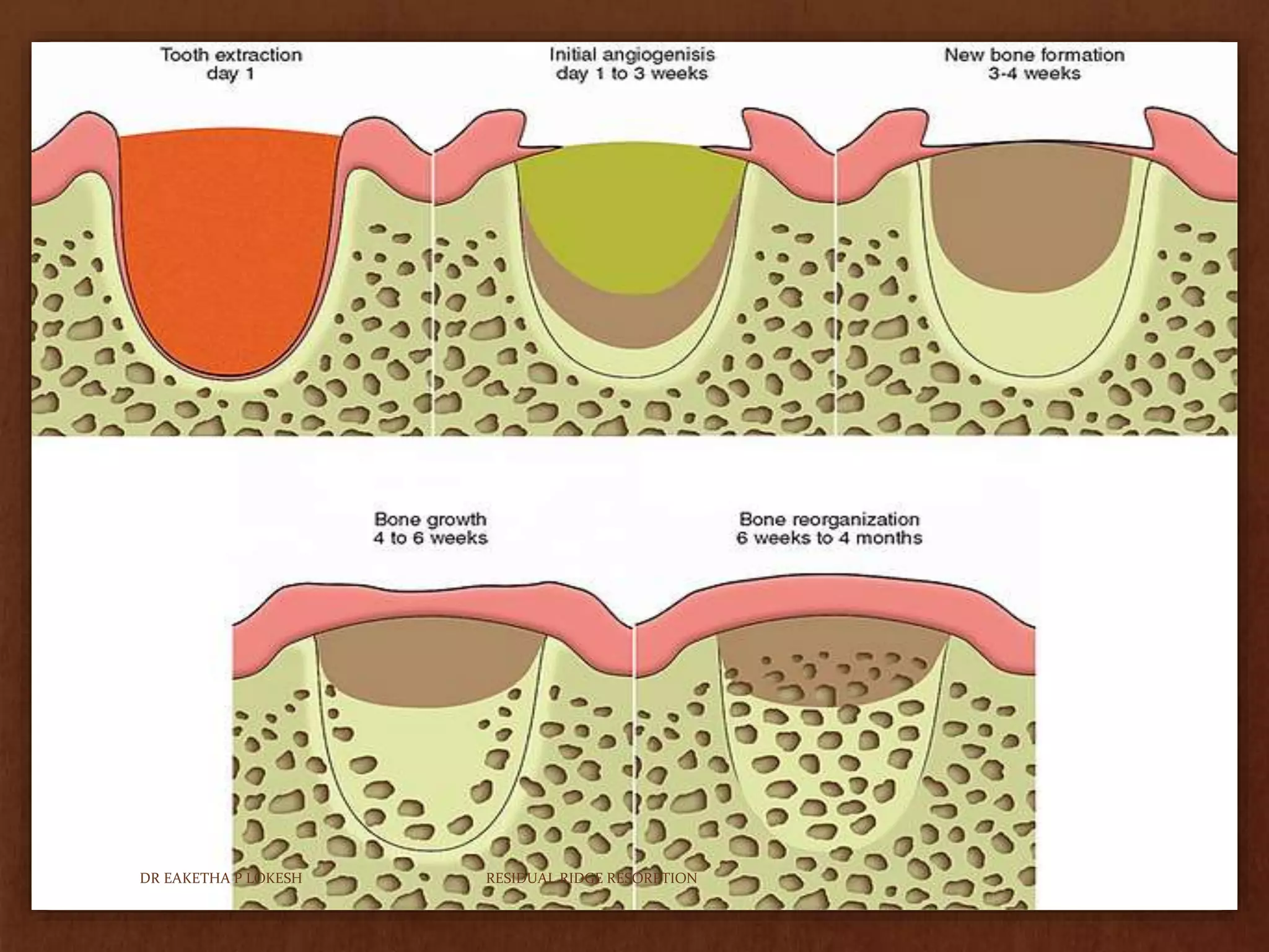 Residual ridge resorption - RRR | PPTX