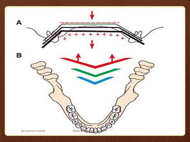 Residual ridge resorption - RRR | PPTX