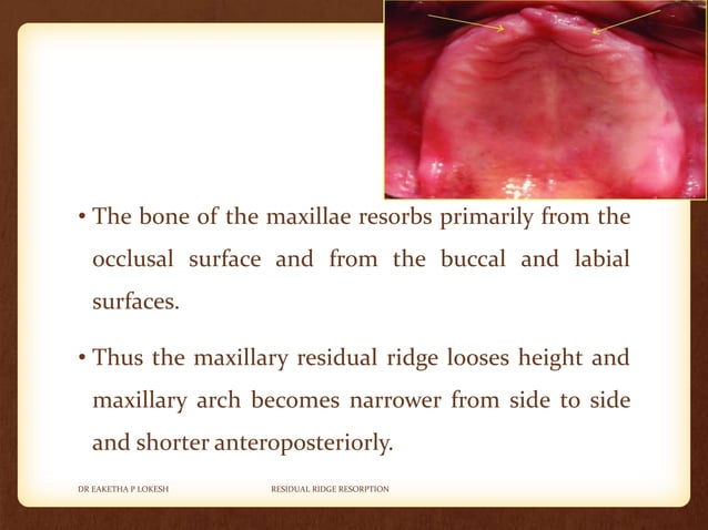 Residual ridge resorption - RRR | PPTX