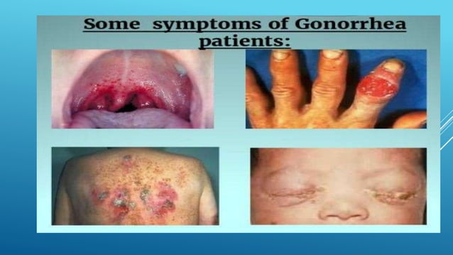Sex Transmitted Diseases Ppt