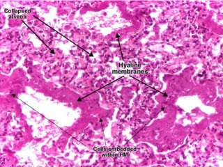 Atelectasis Histology