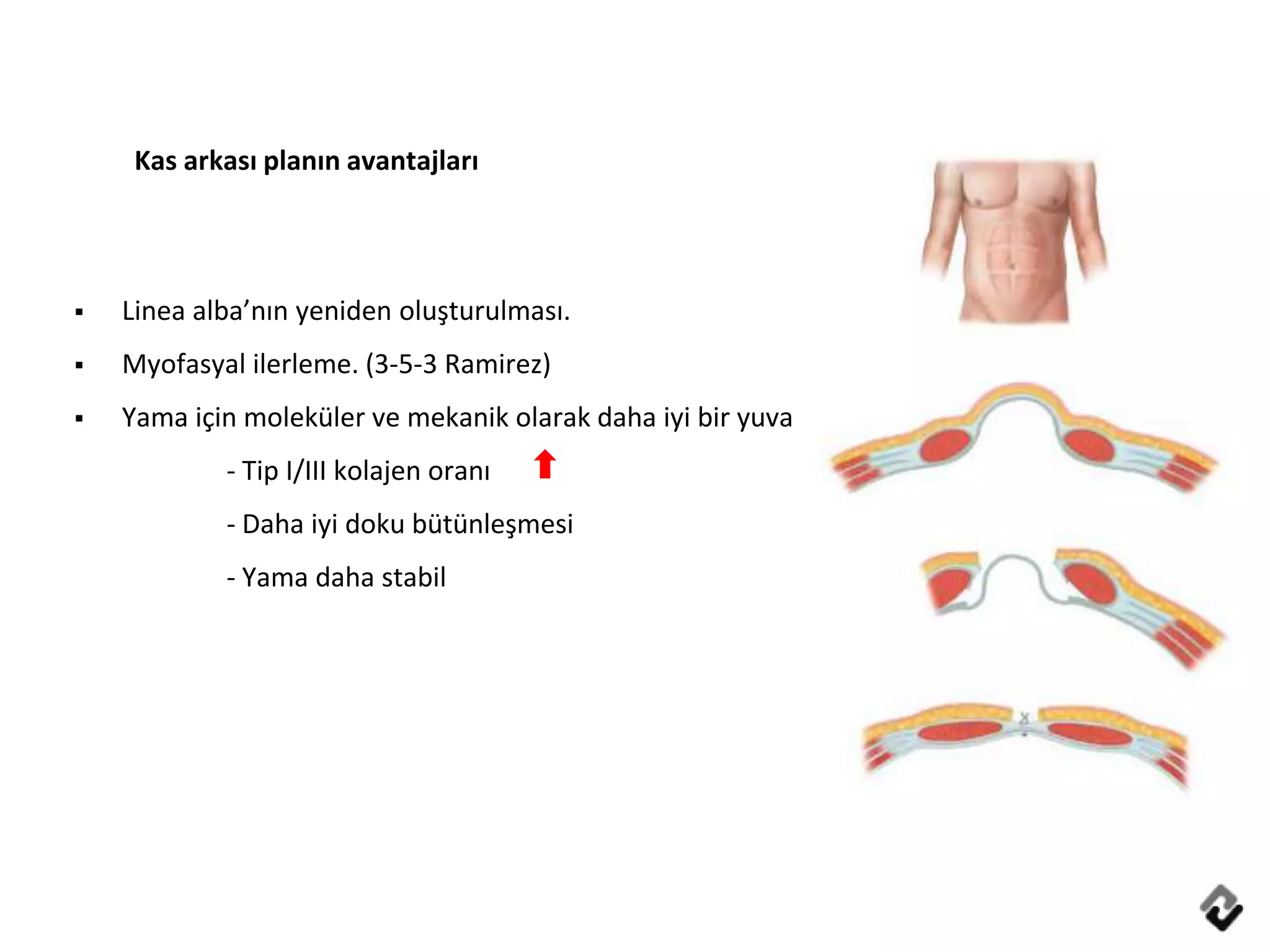 Rives-Stoppa technique | PPTX