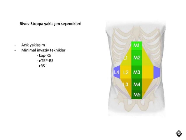 Rives-Stoppa technique | PPTX