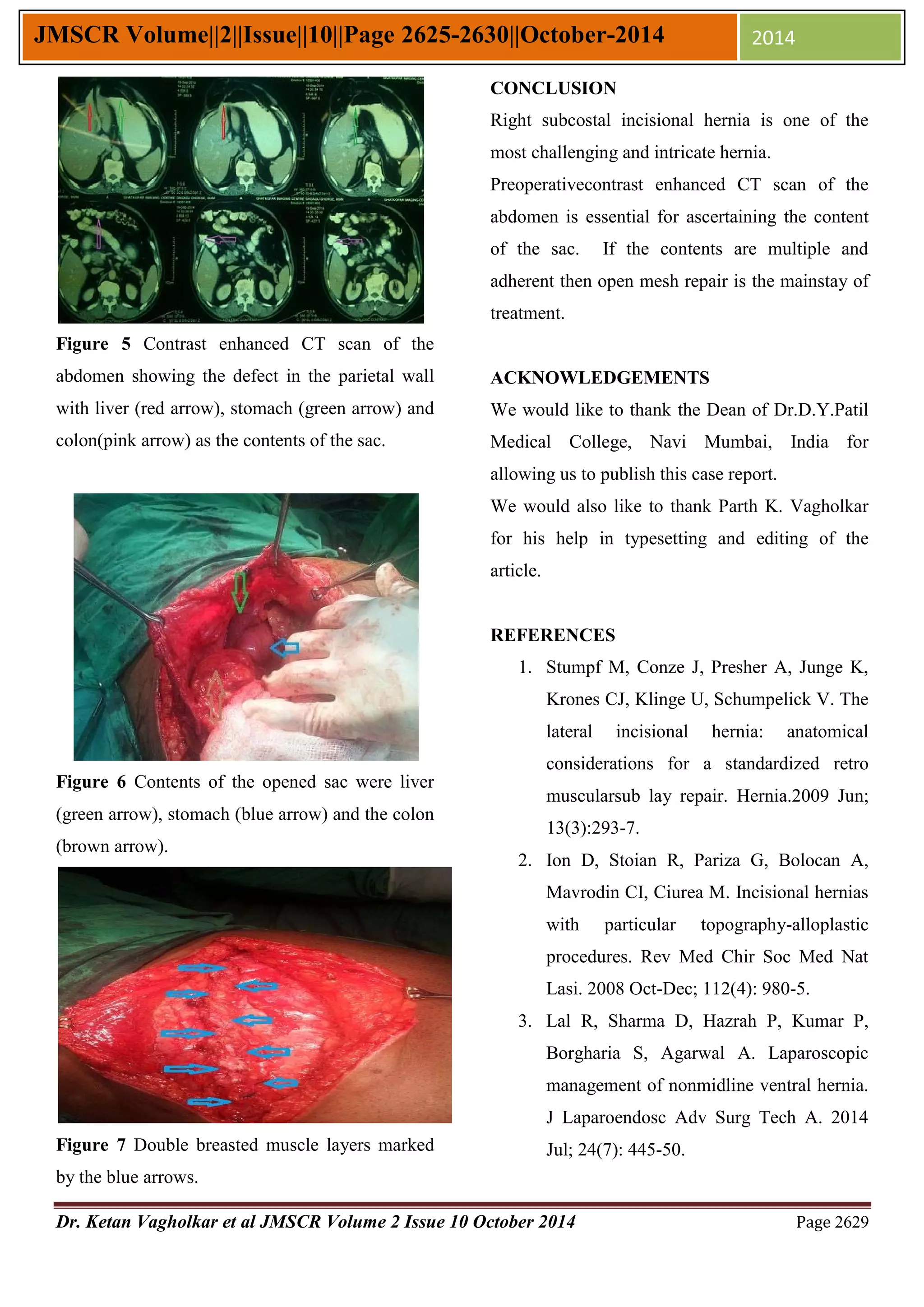 Right Subcostal Incisional Hernia: A Surgical Challenge. | PDF