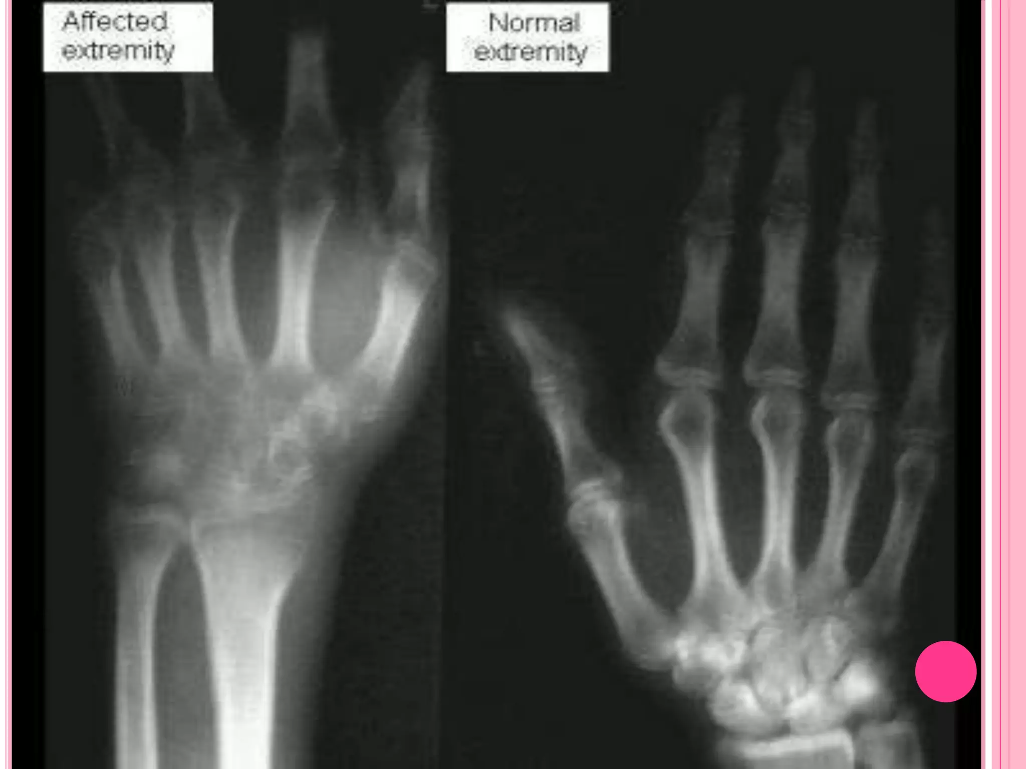 RSD-REFLEX SYMPATHETIC DYSTROPHY | PPTX