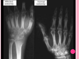 RSD-REFLEX SYMPATHETIC DYSTROPHY | PPTX | Brain and Nervous System ...
