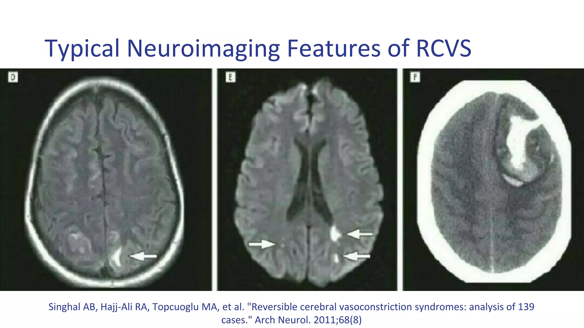 R Shravani RCVS Grand Rounds final .ppt
