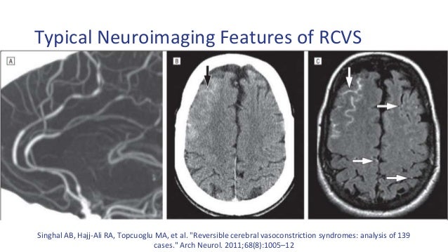R Shravani RCVS Grand Rounds final .ppt