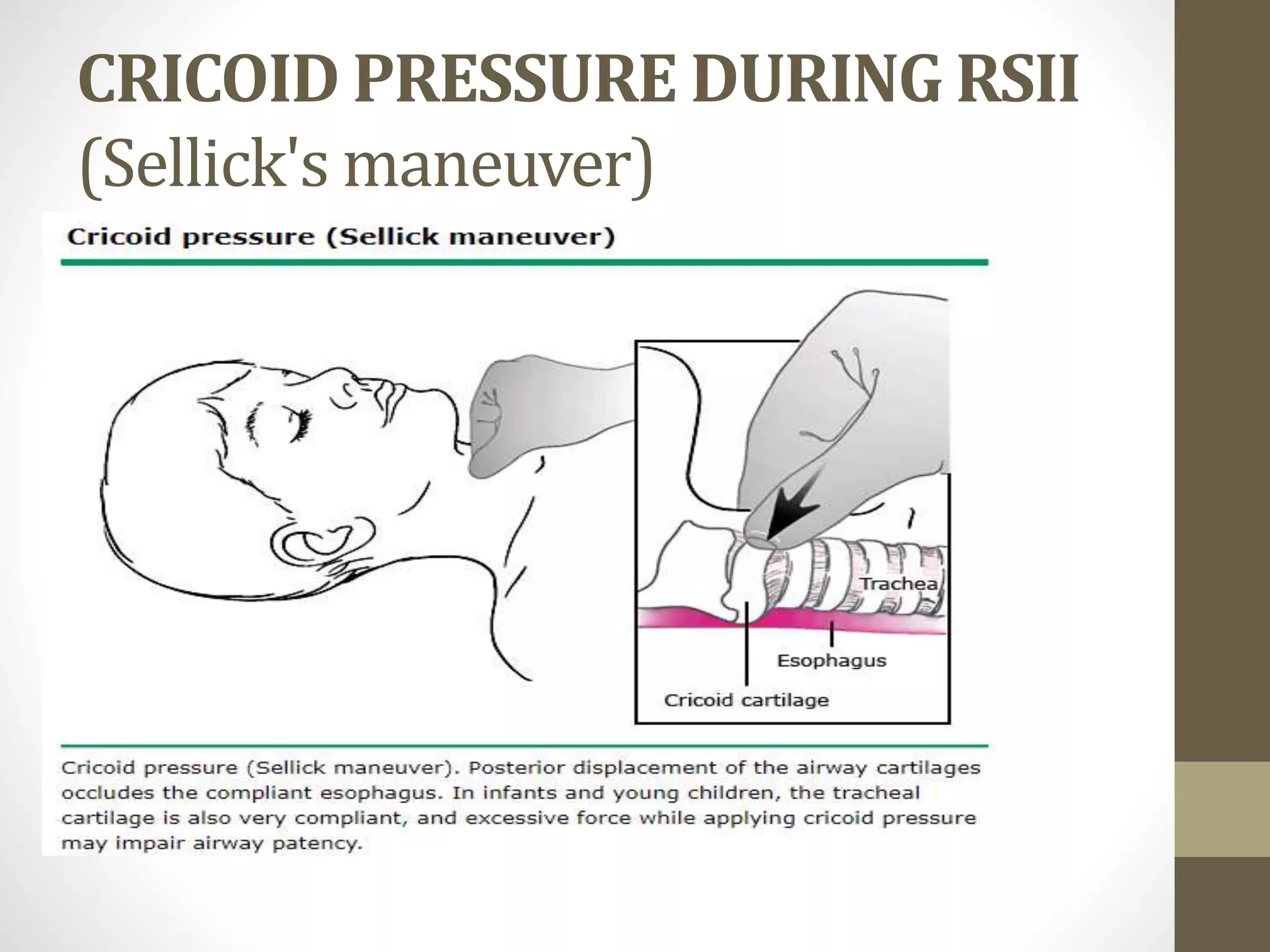 Rapid Sequence Induction & Intubation | PPTX