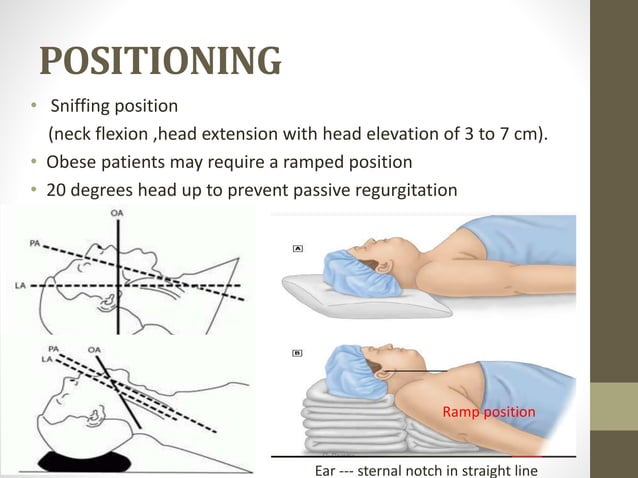 Rapid Sequence Induction & Intubation | PPT