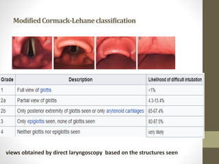 Rapid Sequence Induction & Intubation | PPT