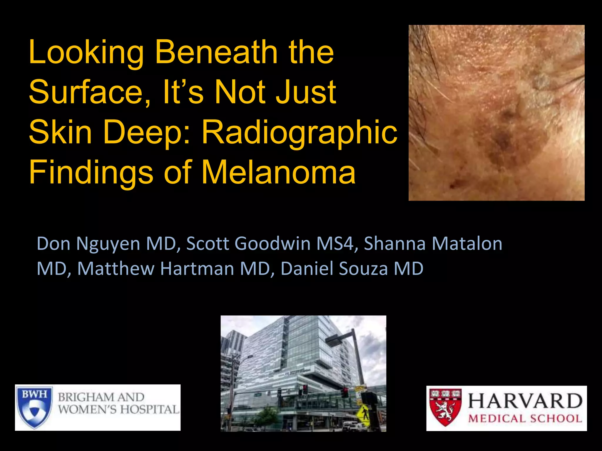 Radiographic Findings of Melanoma | PPTX
