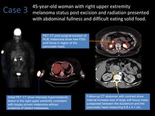 Radiographic Findings of Melanoma | PPTX