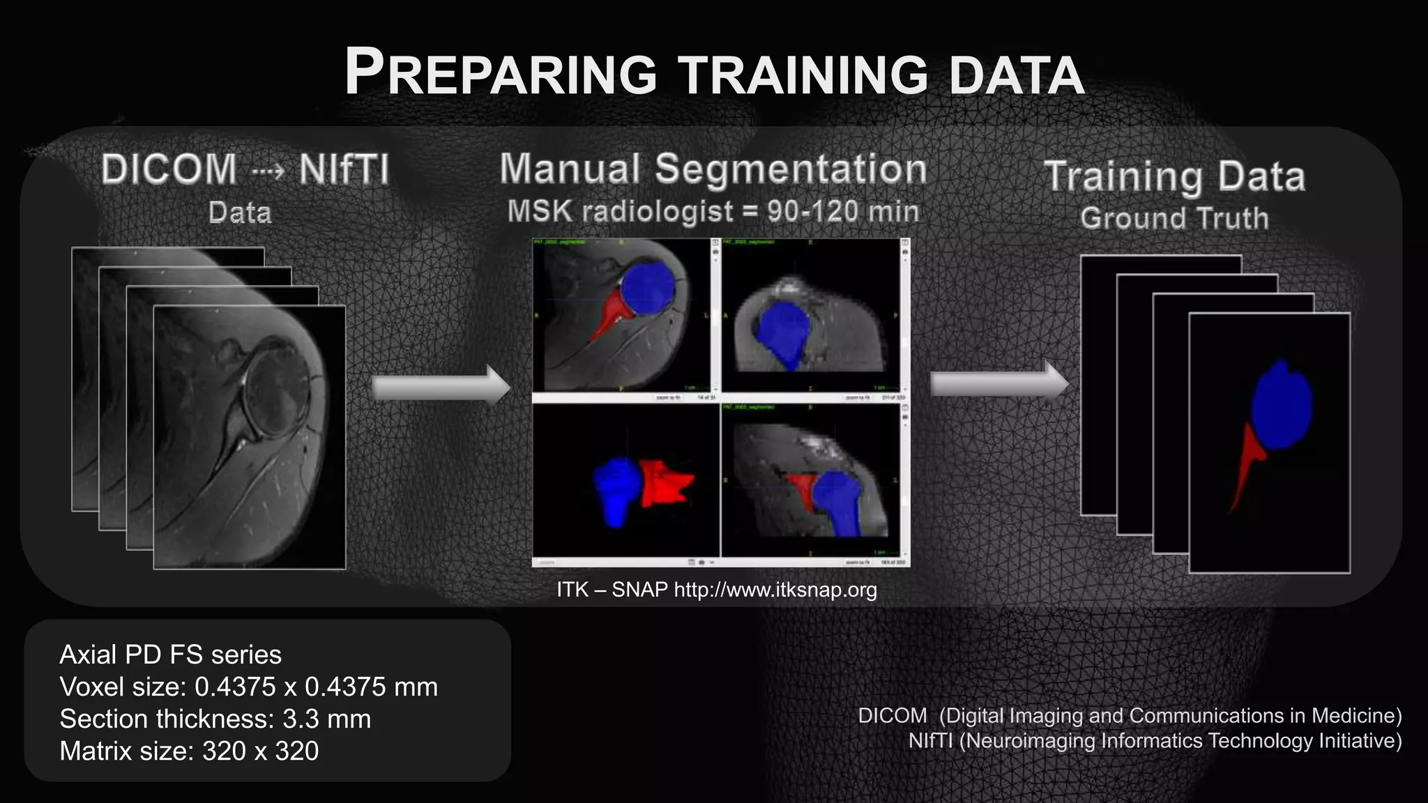 Fully Automated Mri Bone Segmentation Of Glenoid And Humeral Head Using Deep Convolutional