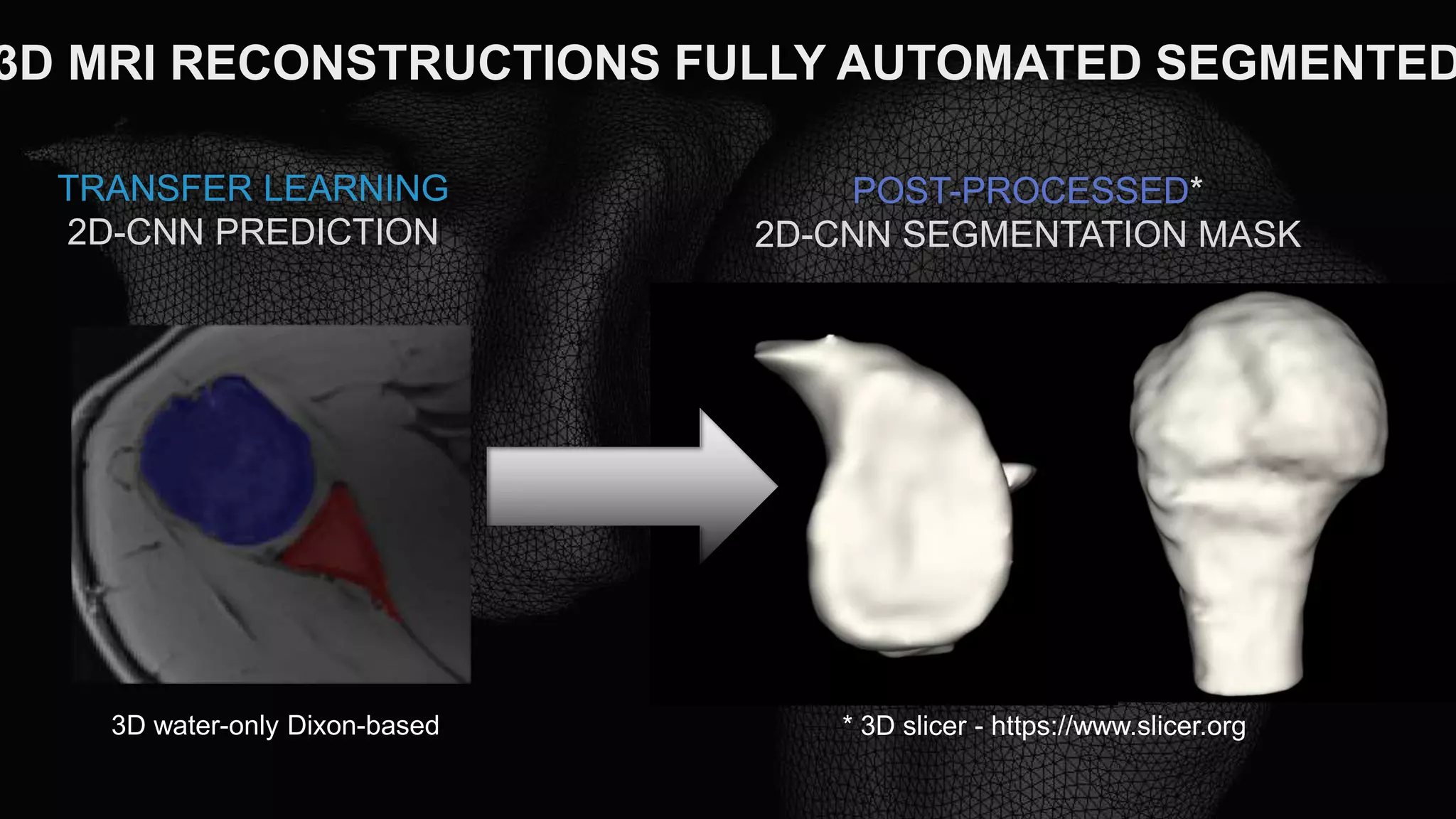 Fully Automated Mri Bone Segmentation Of Glenoid And Humeral Head Using Deep Convolutional