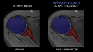 "Fully Automated MRI Bone Segmentation of Glenoid and Humeral Head ...