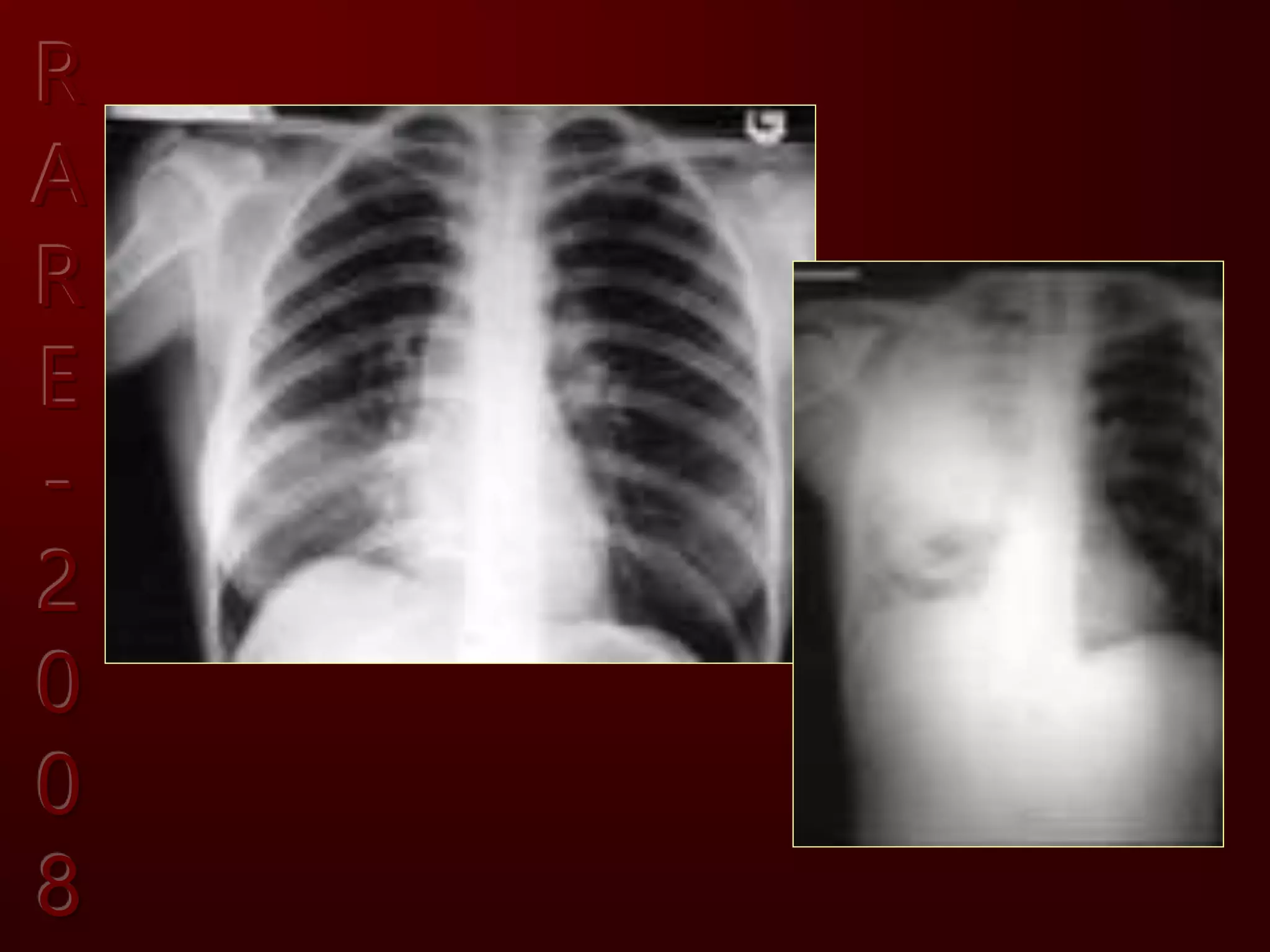 Respiratory system signs final.ppt radiology | PPT