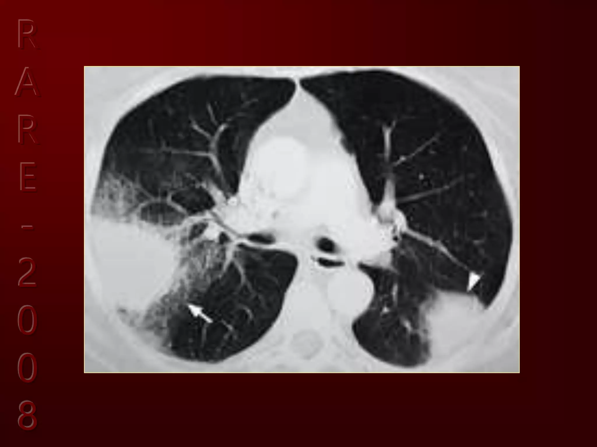 Respiratory system signs final.ppt radiology | PPT