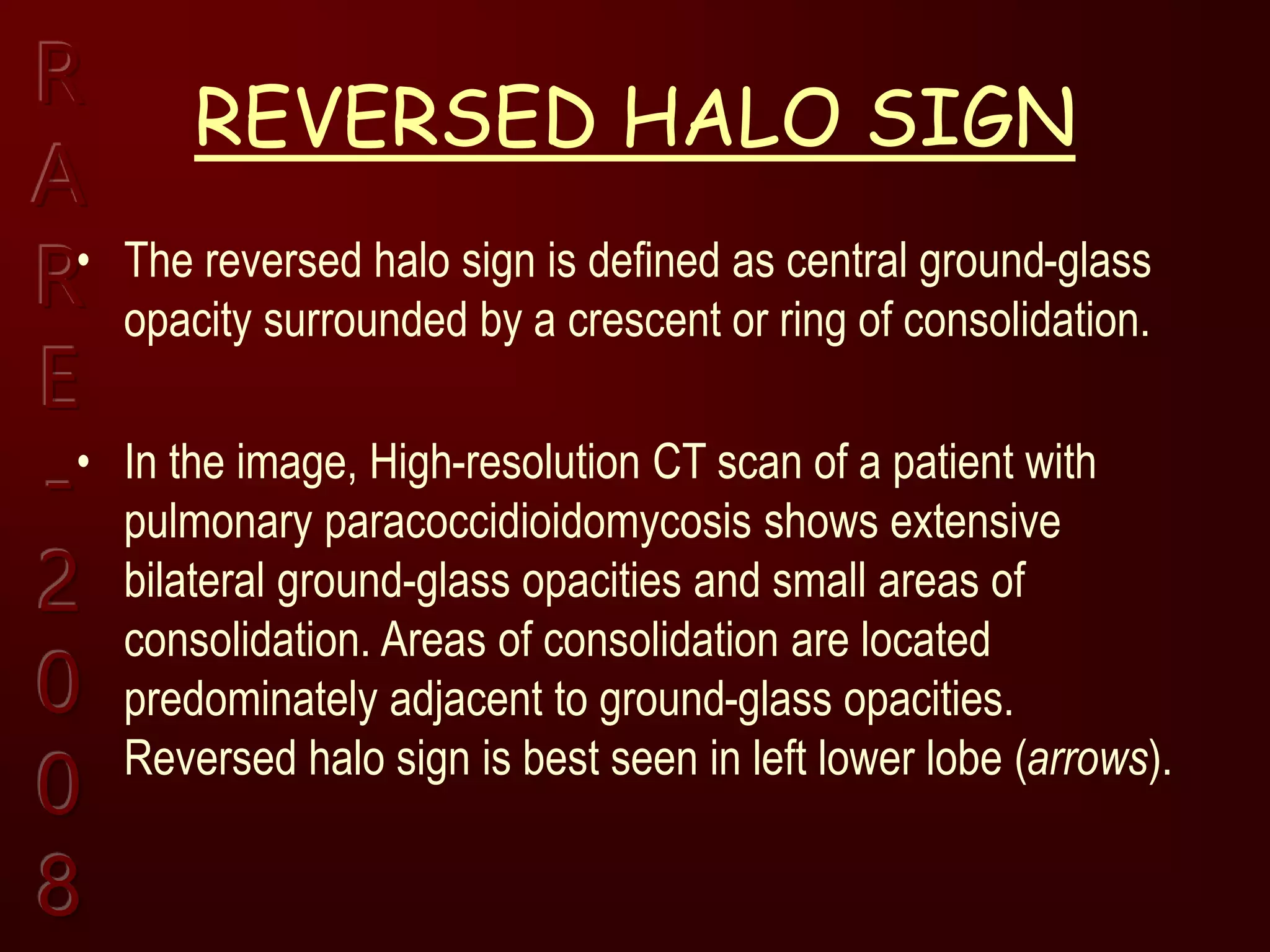 Respiratory system signs final.ppt radiology | PPT