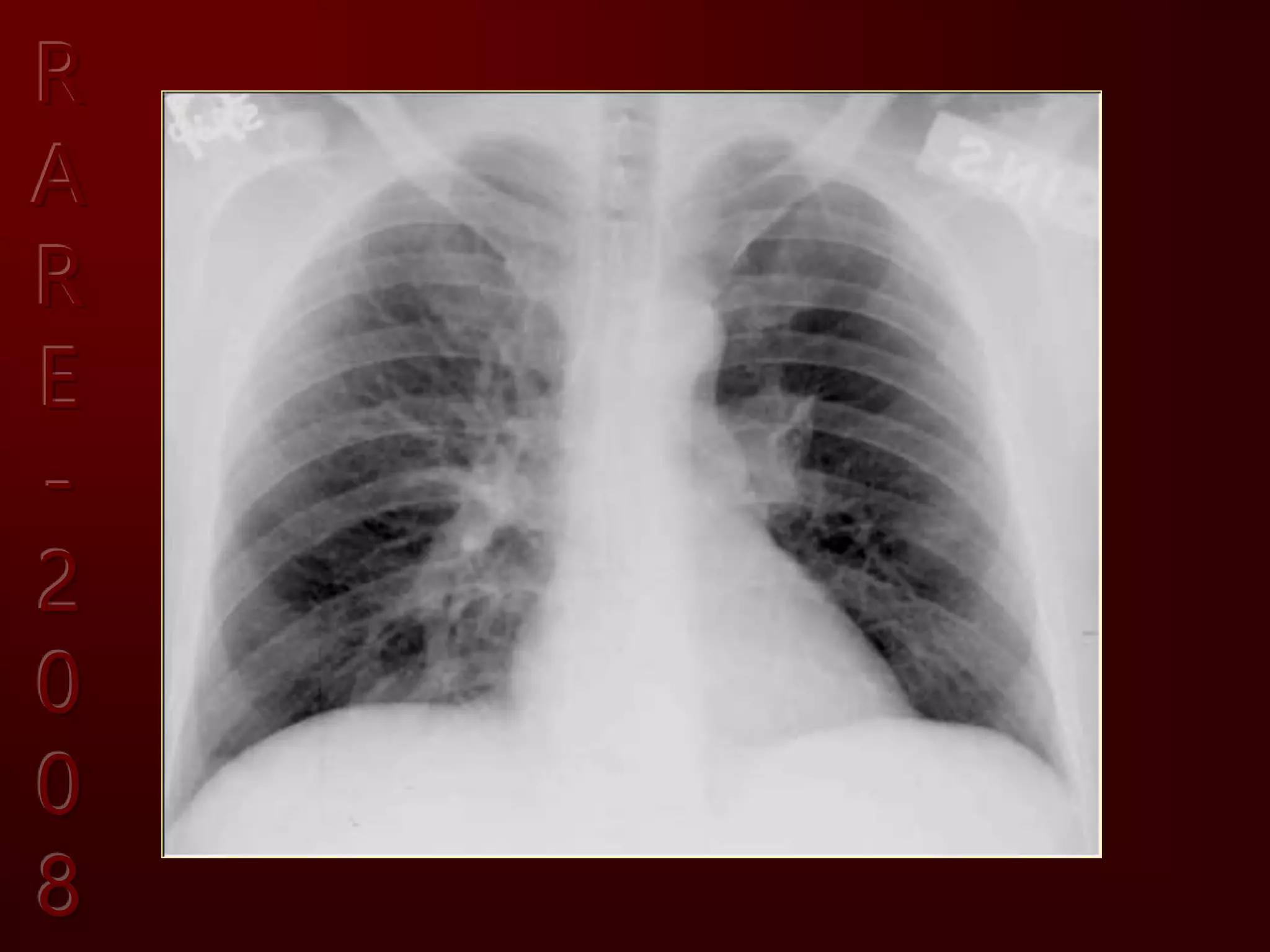 Respiratory system signs final.ppt radiology | PPT