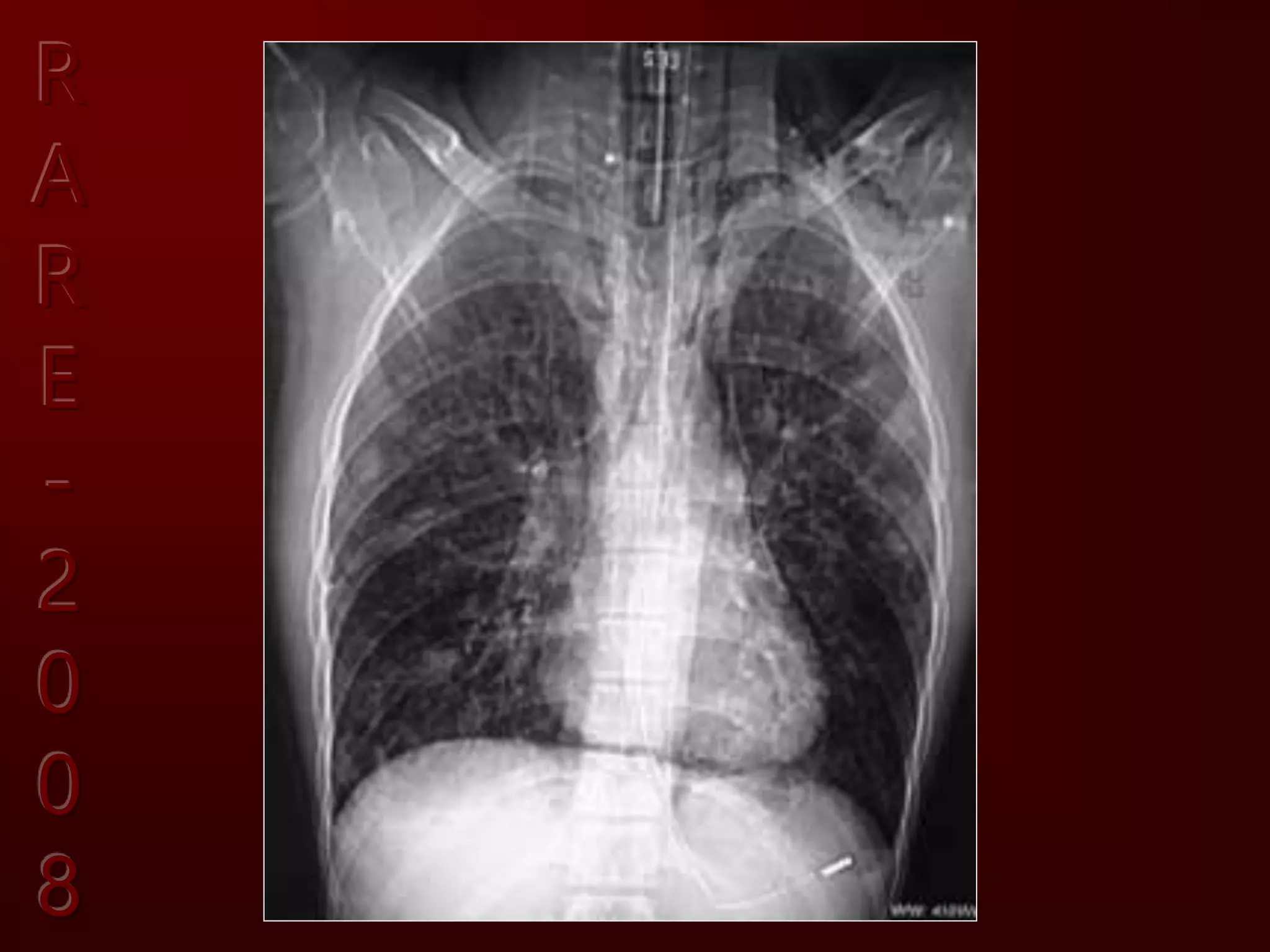Respiratory system signs final.ppt radiology | PPT