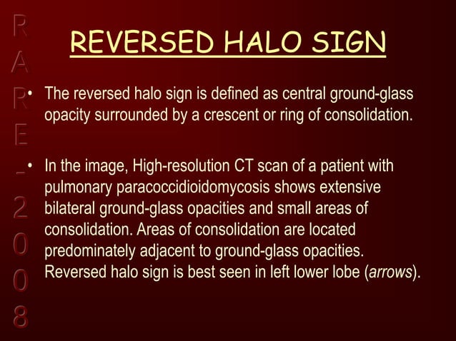 Respiratory system signs final.ppt radiology | PPT | Lung and ...