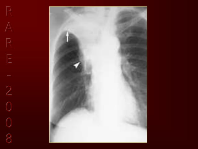 Respiratory system signs final.ppt radiology | PPT | Lung and ...