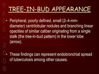 Respiratory system signs final.ppt radiology | PPT | Lung and ...