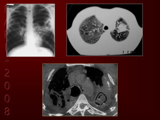 Respiratory system signs final.ppt radiology | PPT