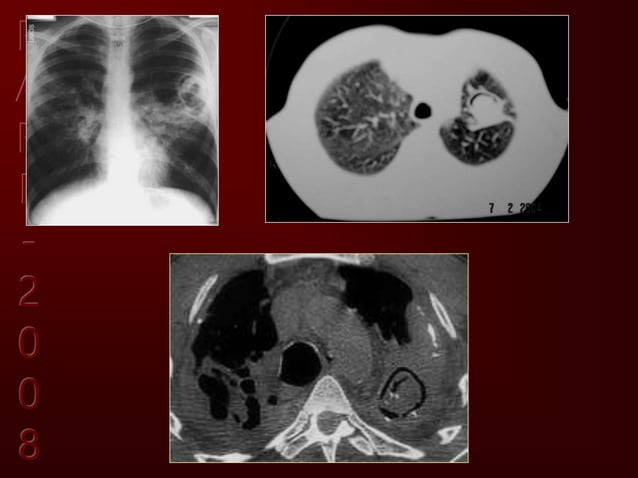 Respiratory system signs final.ppt radiology | PPT | Lung and ...