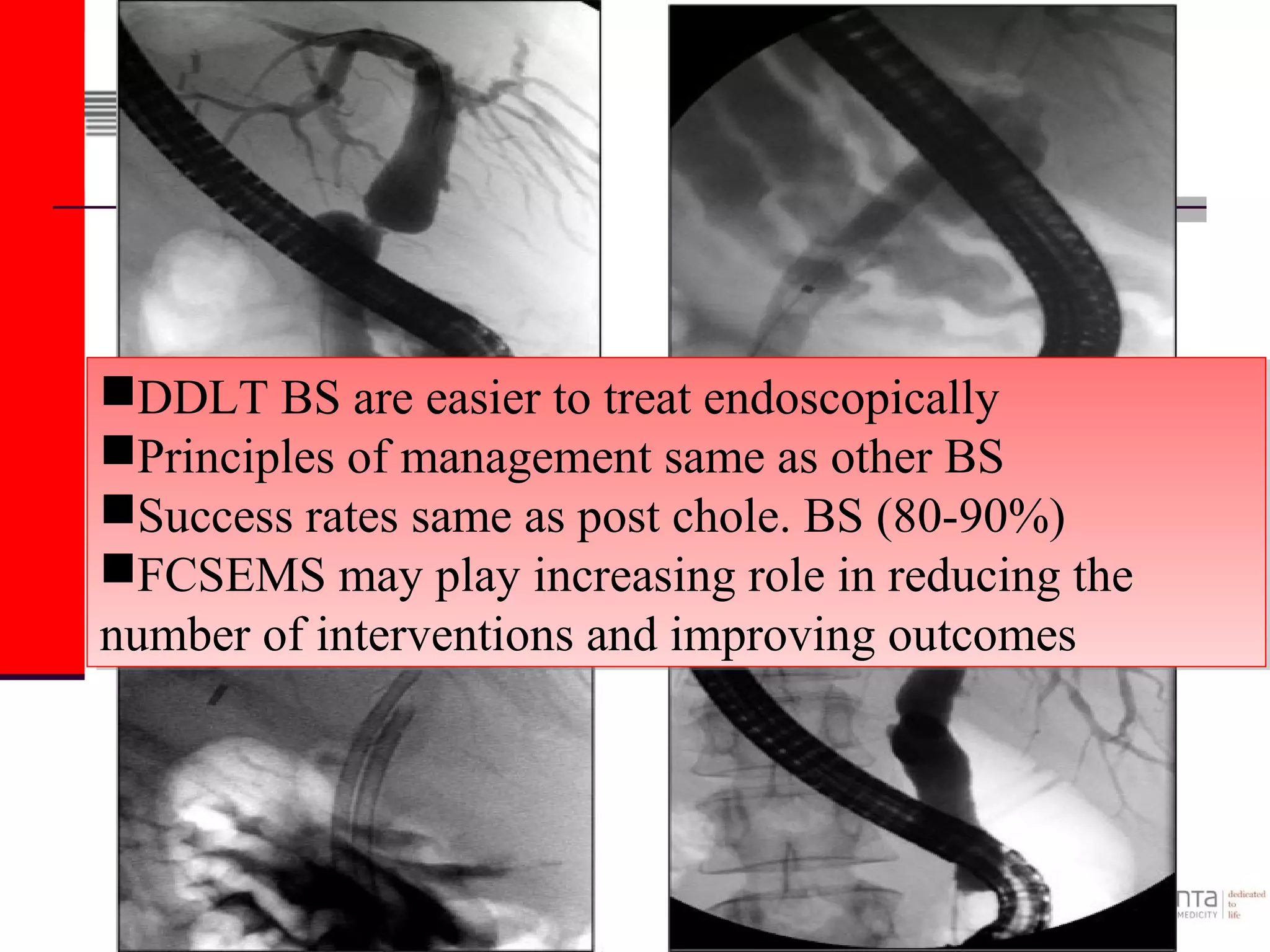 Endoscopic management of Post liver transplant - Bilary Complications | PPT
