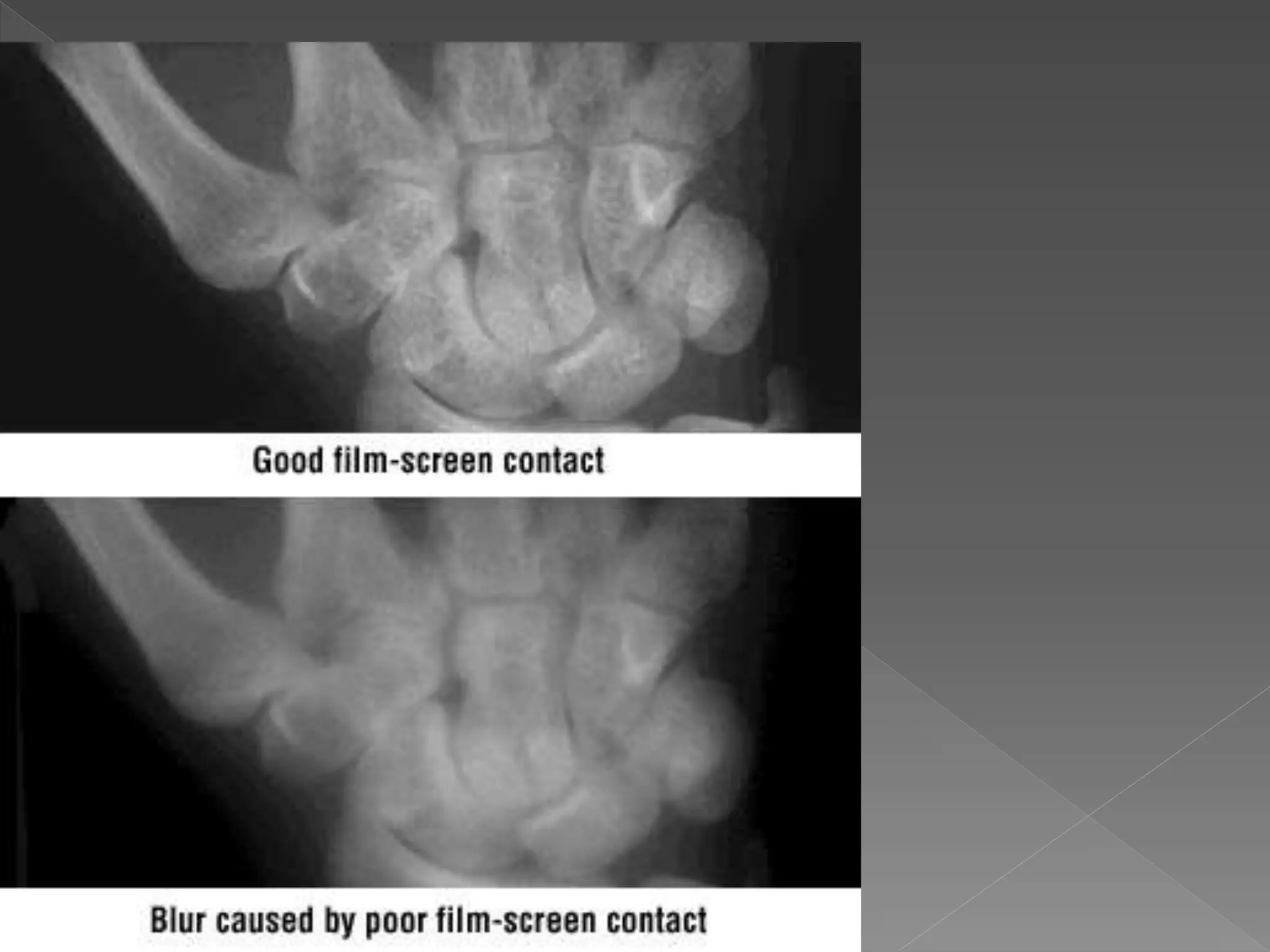 Intensifying Screen (x-ray) | PPTX