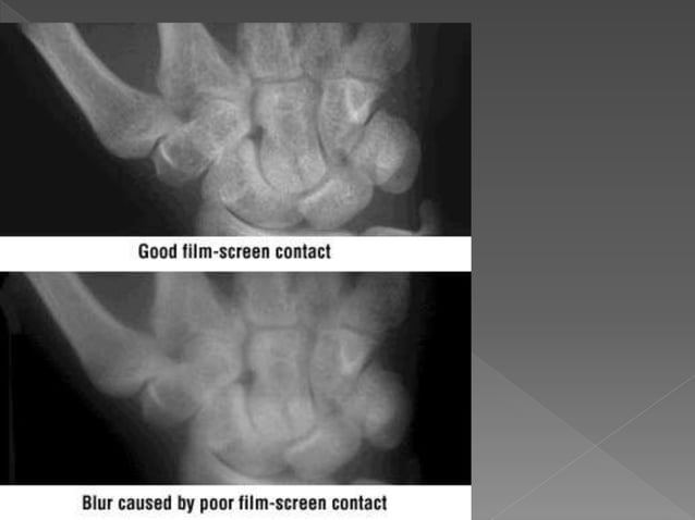 Intensifying Screen (x-ray) | PPTX