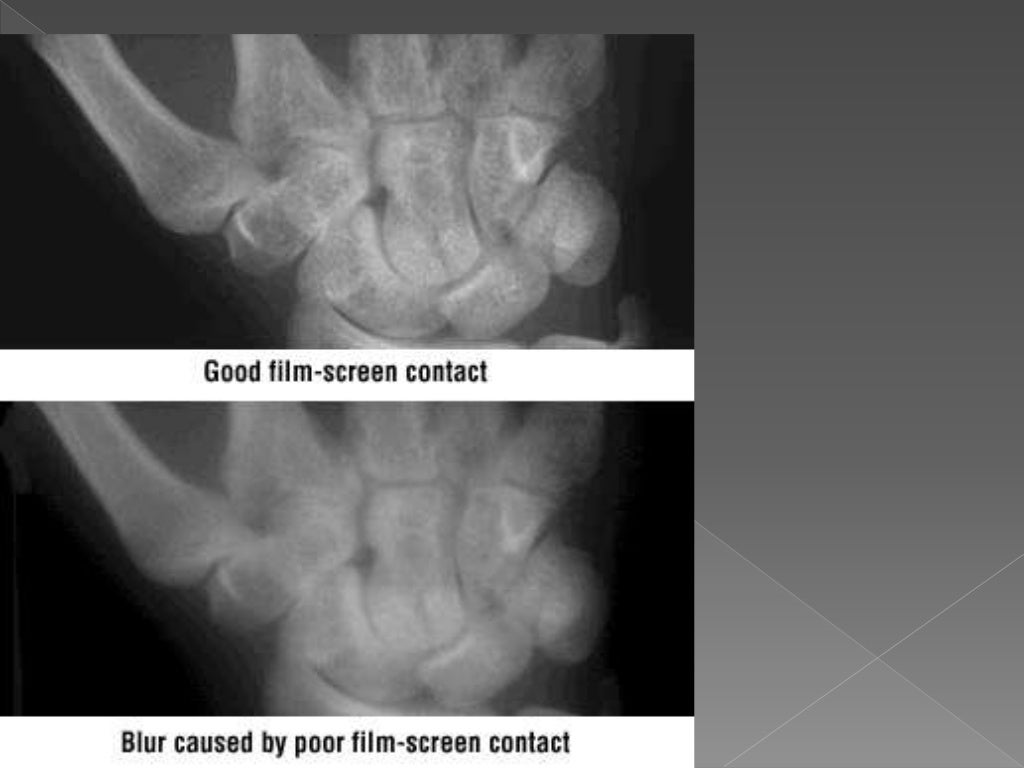 Intensifying Screen (x-ray)