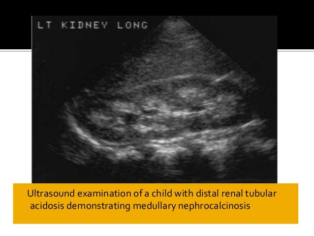 Renal Tubular Acidosis Pediatrics