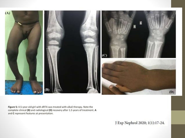 RENAL TUBULAR ACIDOSIS IN CHILDREN | PPTX