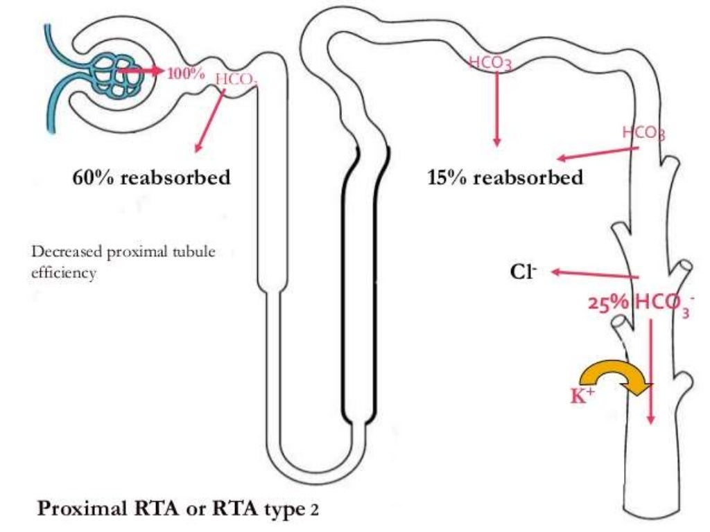 Renal Tubular Acidosis Types And Key Findings - vrogue.co