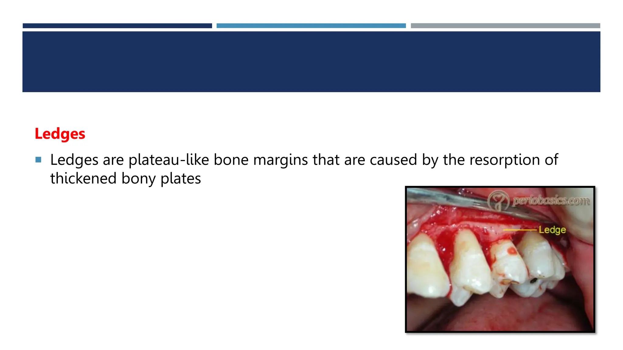 BONE LOSS PATTERN in periodontal diseasepptx | PPTX