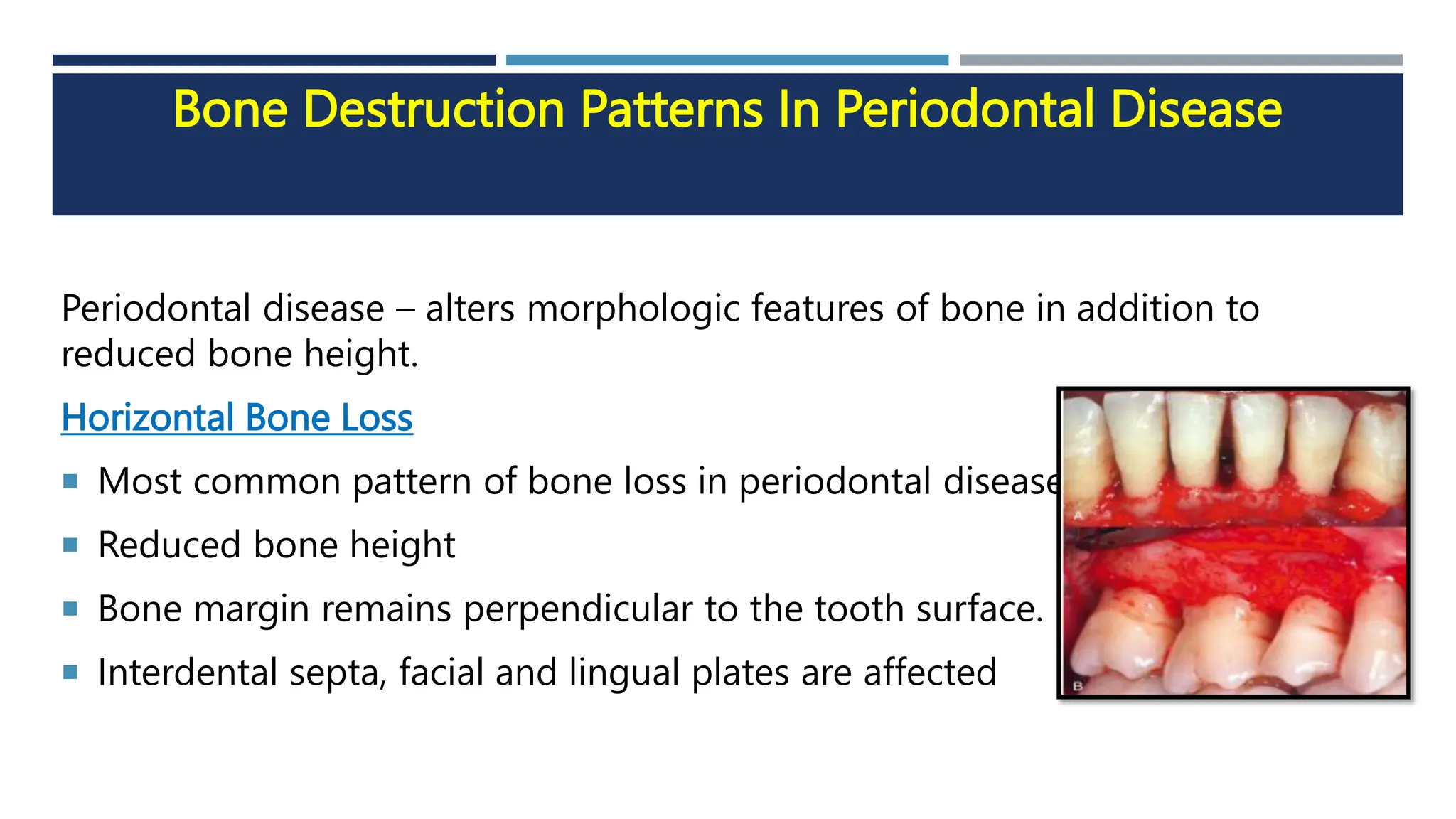 BONE LOSS PATTERN in periodontal diseasepptx | PPTX