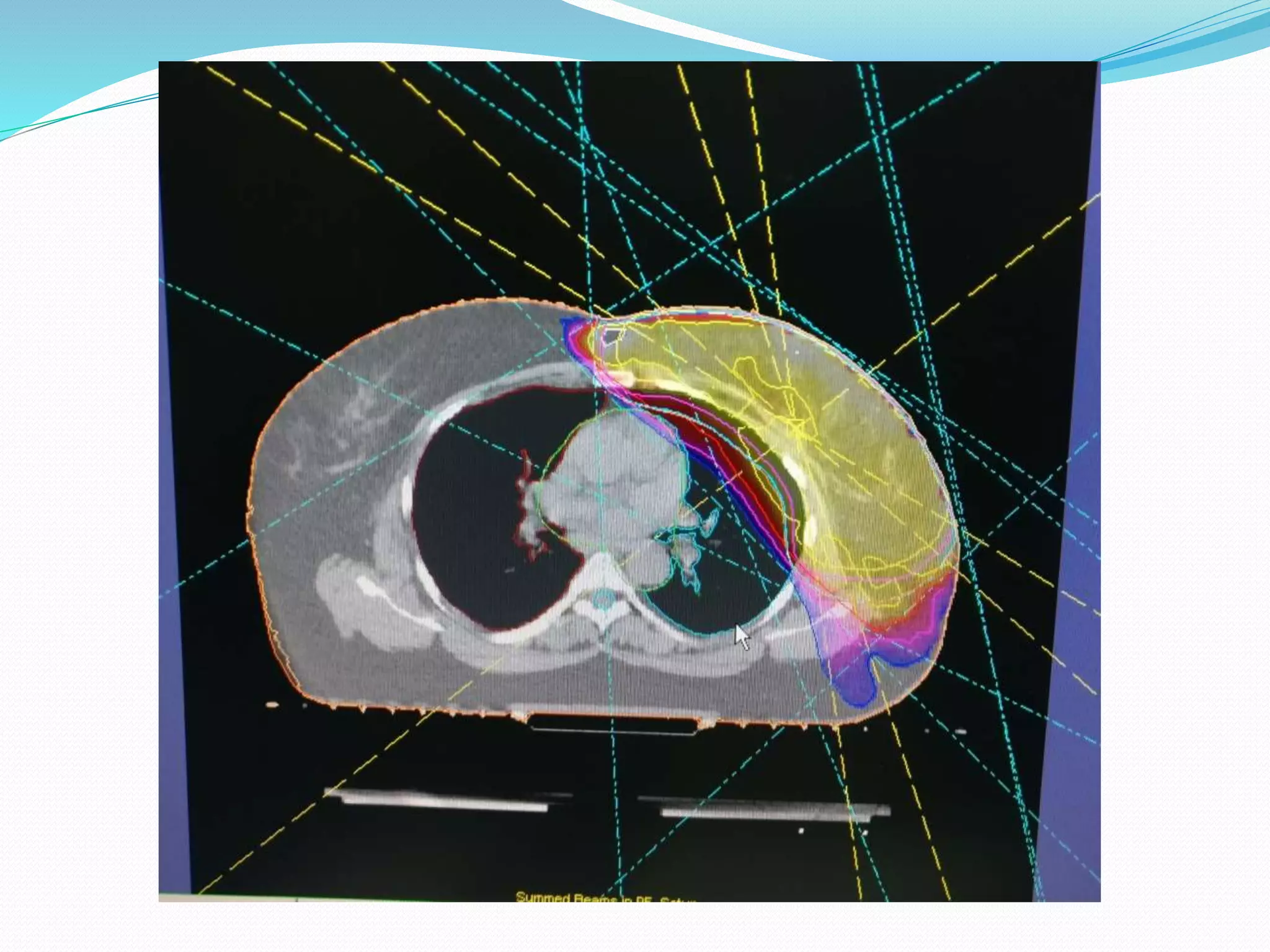 RT breast apbi | PPTX