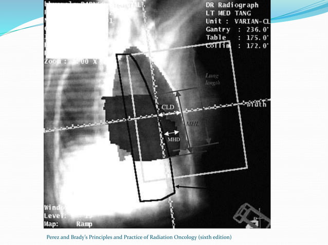 RT breast apbi | PPTX