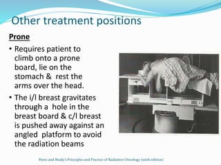 Radiotherapy breast | PPTX