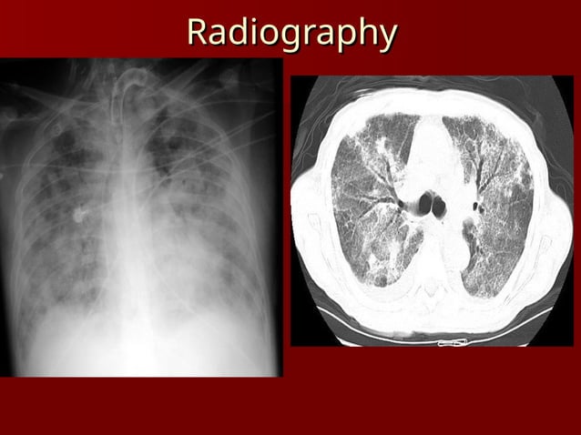 RTC ARDS powerpoint presentation for msc | PPT
